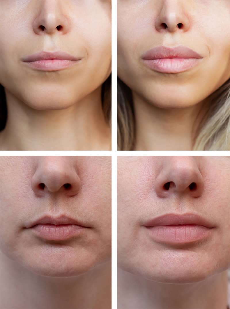 Dermal Fillers in Charleston, SC | Youth Lab Medical Spa